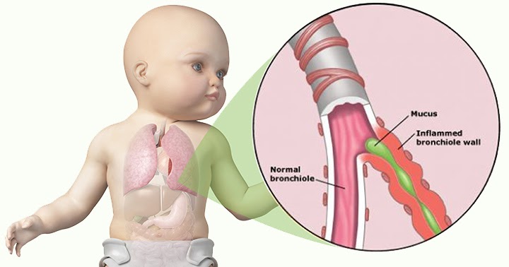 Pediatrics Notes: Clinical Manifestations of Bronchiolitis