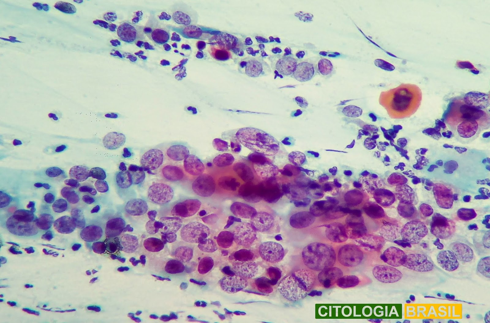 CARCINOMA ESCAMOSO - Citologia Brasil