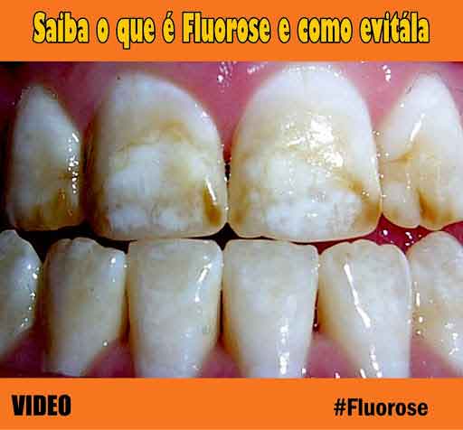 FLUOROSE DENTÁRIA : Saiba o que é Fluorose e como evitála