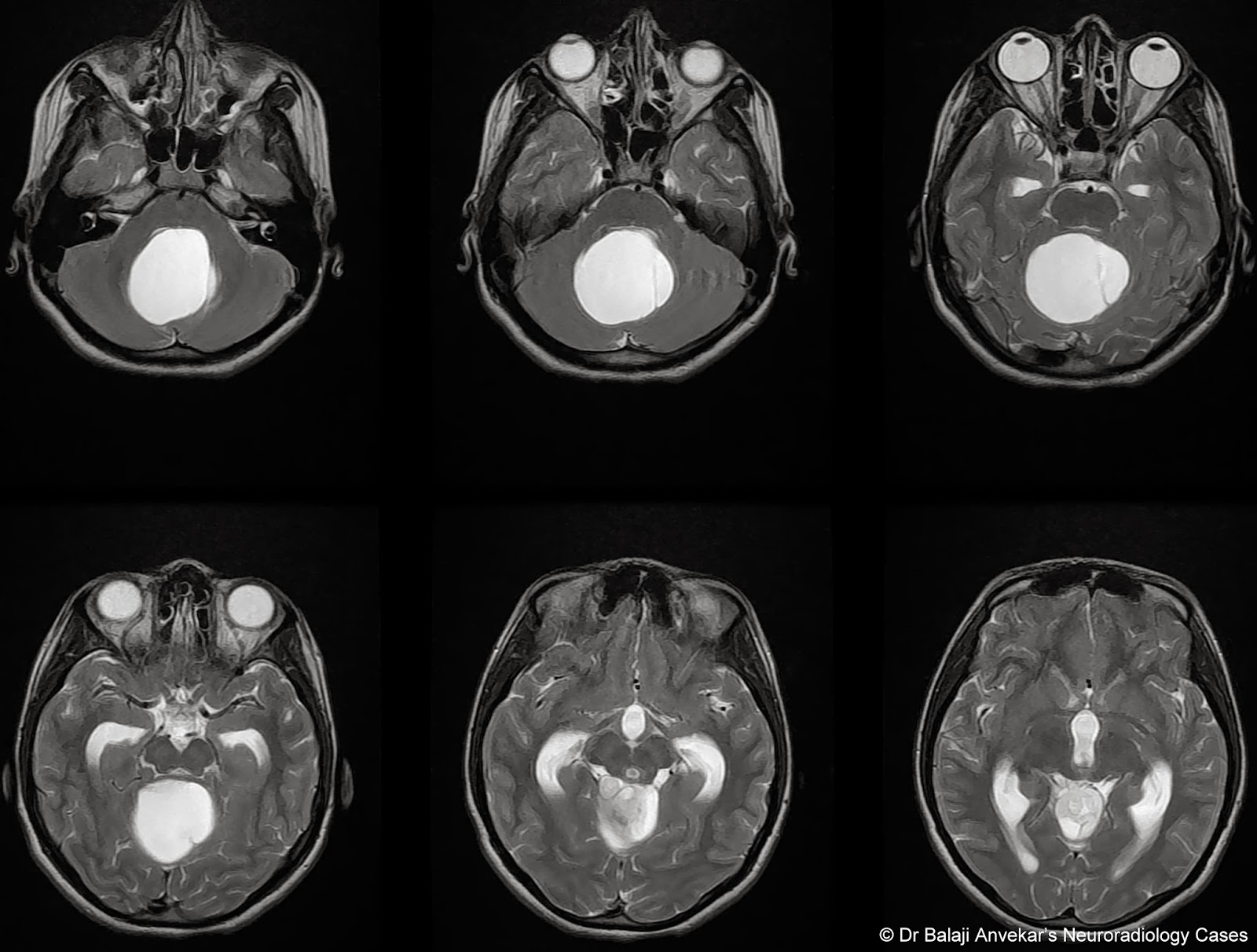Dr Balaji Anvekar FRCR: Posterior fossa cystic mass MRI