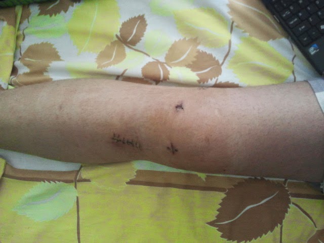 Operacija prednjeg ukrstenog ligamenta i medijalnog meniskusa: Moje ...