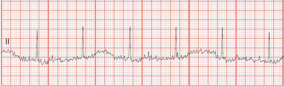 Basic EKG Test 53