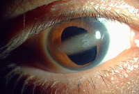 Anomalías de Ojo Externo