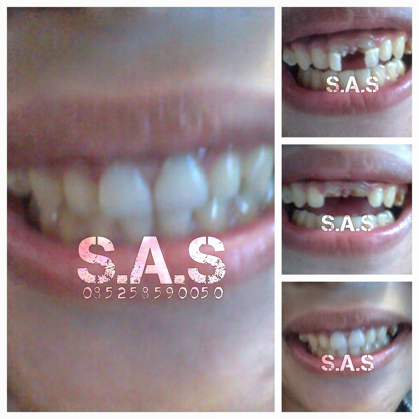 Foto Gigi Palsu (Gigi Tiruan) Lepas Pasang Ala Tukang Gigi S.A.S | S.A ...