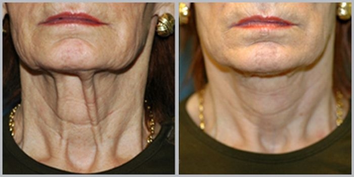 How To Build A Gaunt Neck Into A Fuller Throat Using Neck Toning Workouts
