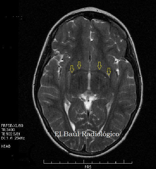 El Baúl Radiológico: COMISURA BLANCA ANTERIOR: ASPECTO EN IRM (Anterior ...