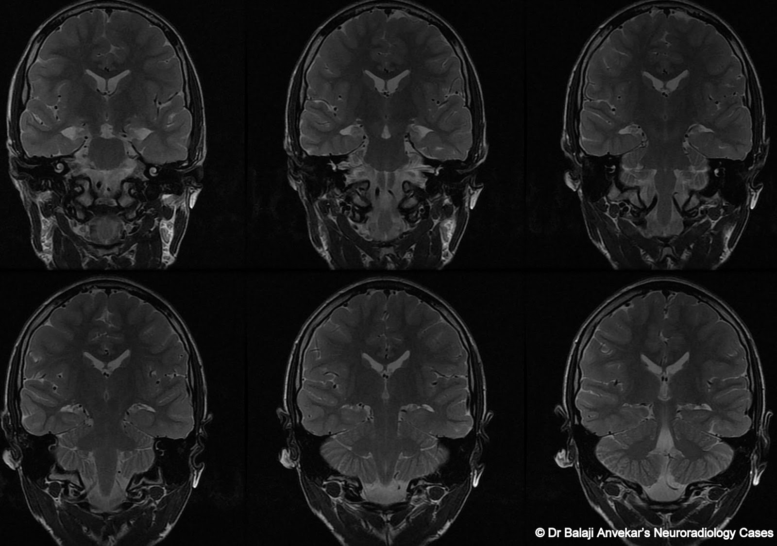 Dr Balaji Anvekar Frcr Bilateral Mesial Temporal Sclerosis Mri