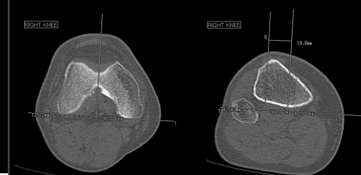 Patellar instability-CT - Sumer's Radiology Blog