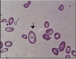 Células importantes en hematología: OVALOCITOS