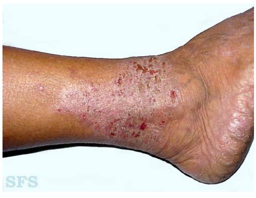 Bekam Medis KelapaGading: Eksim