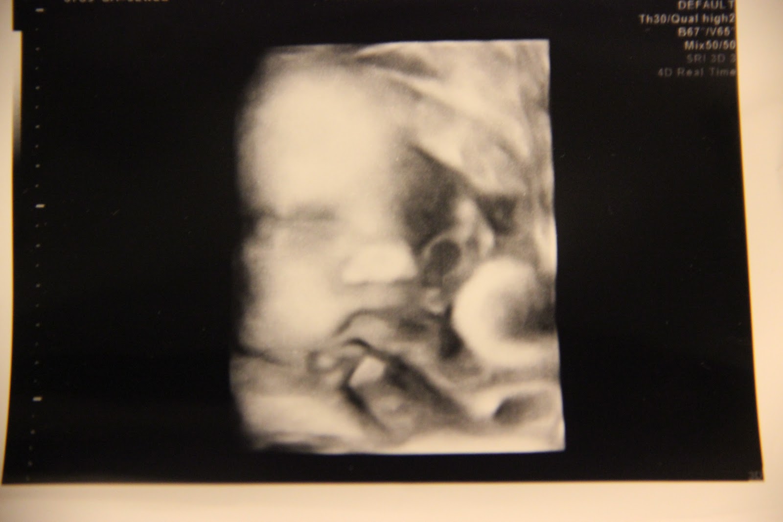 The Johnson Journey: 32 Weeks: Our Baby & Her Kidneys