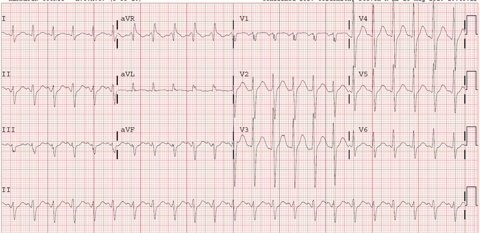 Dr. Smith's ECG Blog: Wide Complex Tachycardia after Ingestion and Seizure