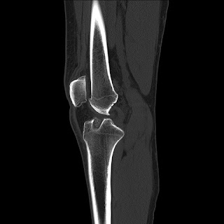 CT Knee - Radiology Imaging