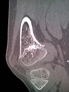 PHYSEAL BAR-CT - Radiology Imaging