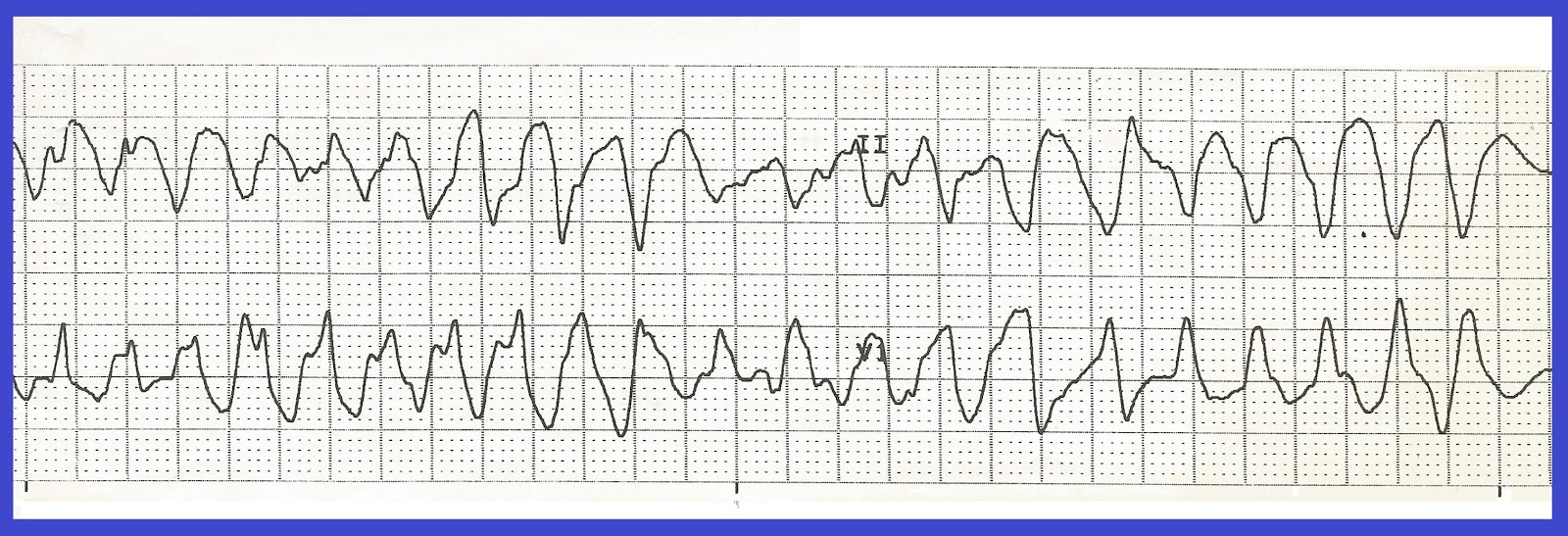 Float Nurse: EKG Rhythm Strip Quiz 174