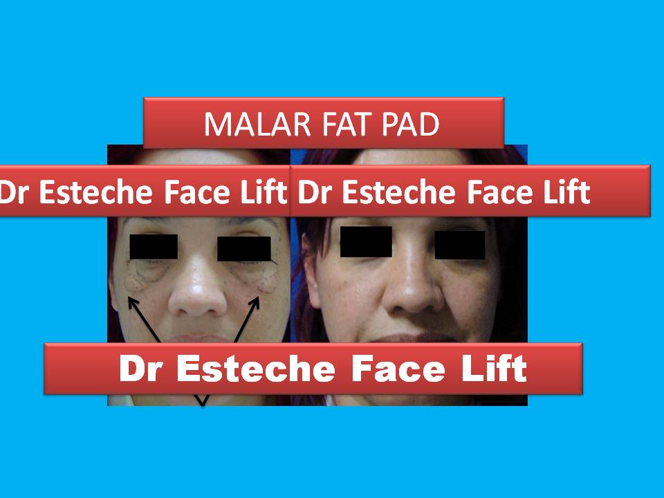 Dr.Esteche | Cirugía Plástica Facial | Cirugía Facial: FACELIFT |19 ...