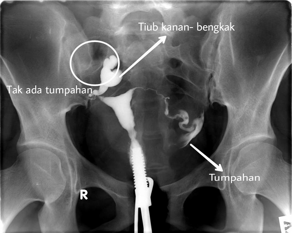 HSG - TIUB SAYA TERSUMBAT KE DOKTOR?