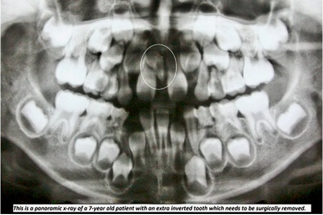 Vouchers 'n More: Children’s Dental Center: P1000 for Complete Dental ...