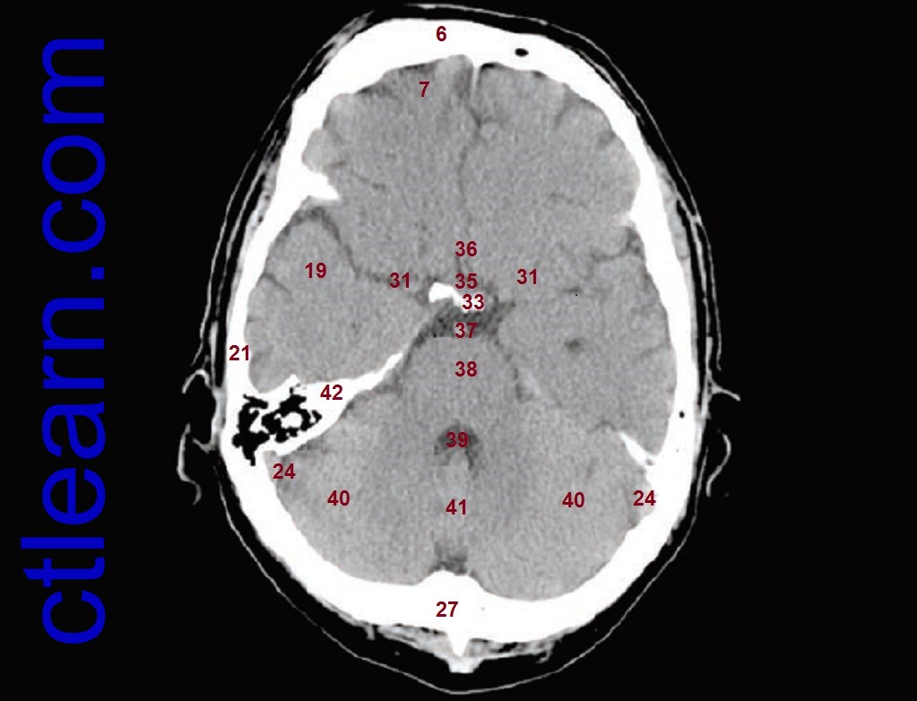Anatomy CT Axial Brain