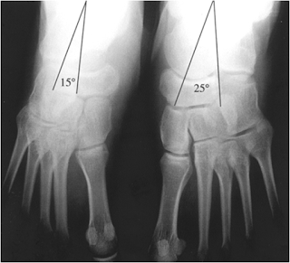 Home: Kaki Pengkor, CTEV, Club Foot, Treatmen