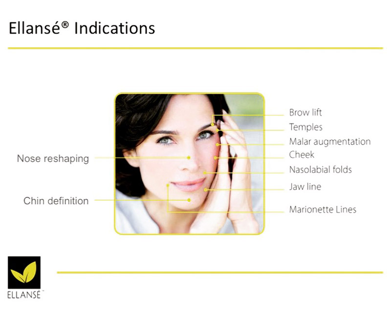 Live A Life You Will Remember : Ellanse Collagen Stimulating Filler 少女针 ...