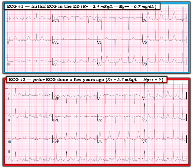 Dr. Smith's ECG Blog: Potassium and Magnesium: how low is too low?