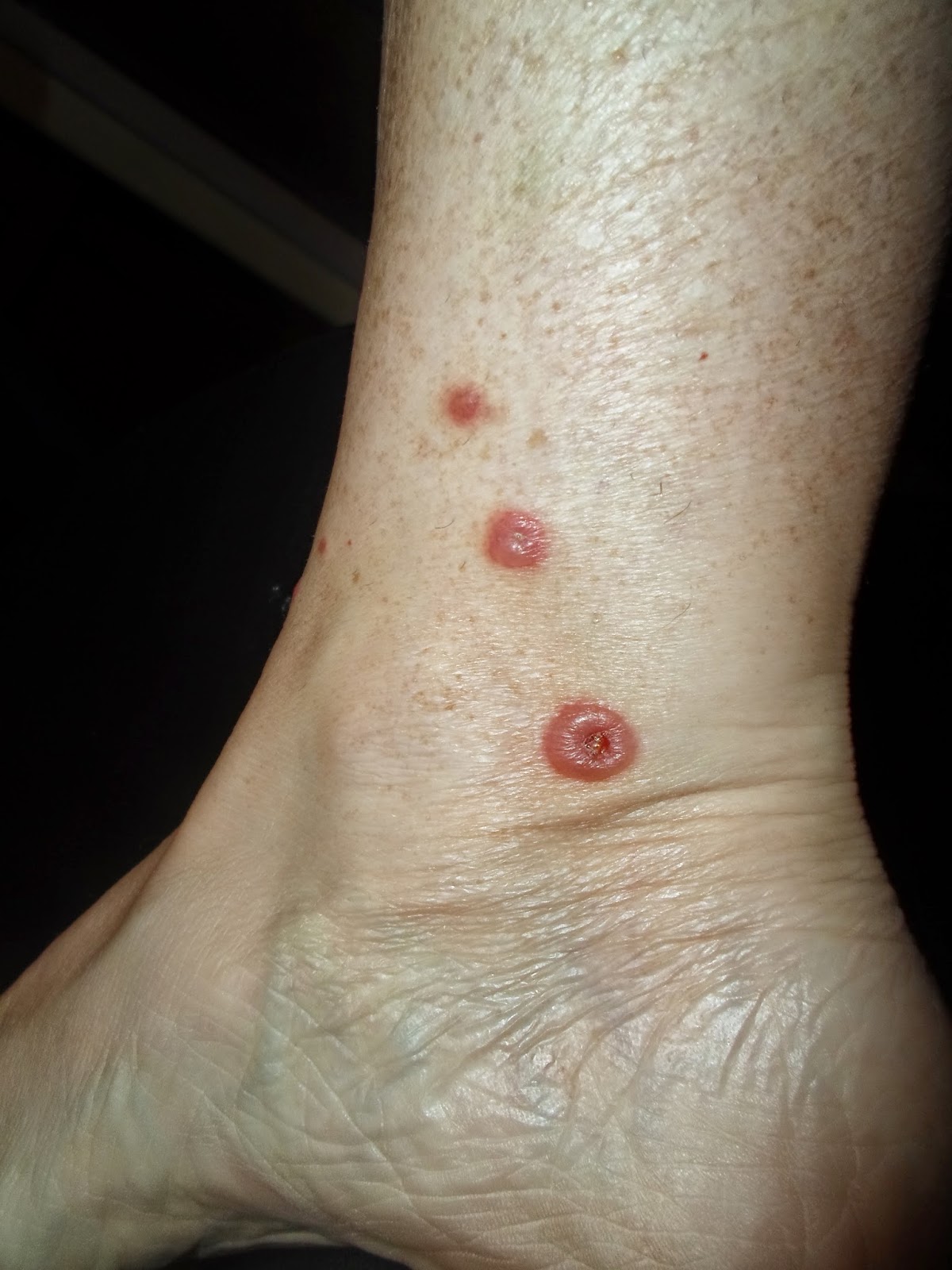 Treating Chigger Bites