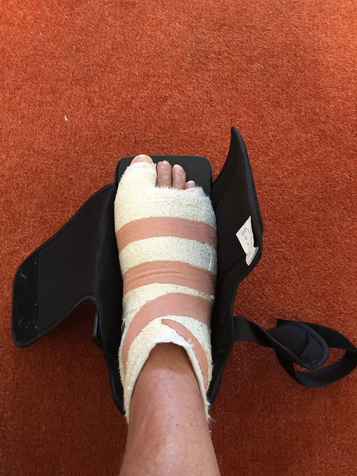 One Boot In Front Of The Other: The Cheilectomy......!!!