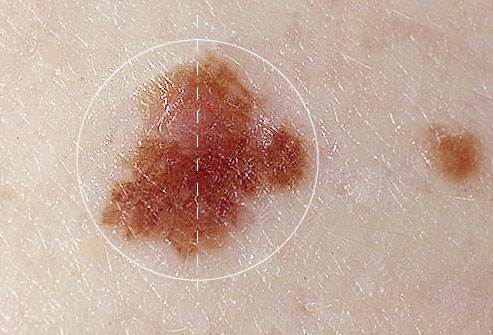 Groin skin cancer in men ~ All about Health