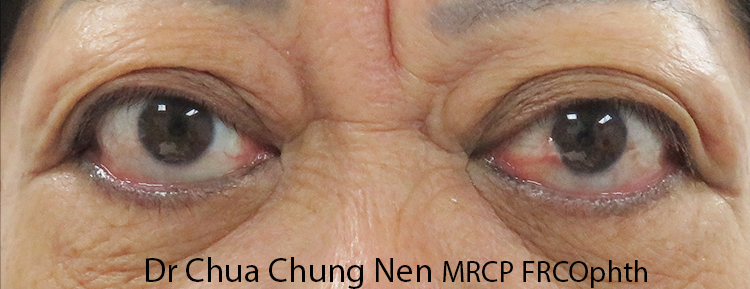 Eyelid Surgery by Prof Dr CN CHUA 蔡鐘能: A hyperthyorid patient with eye ...