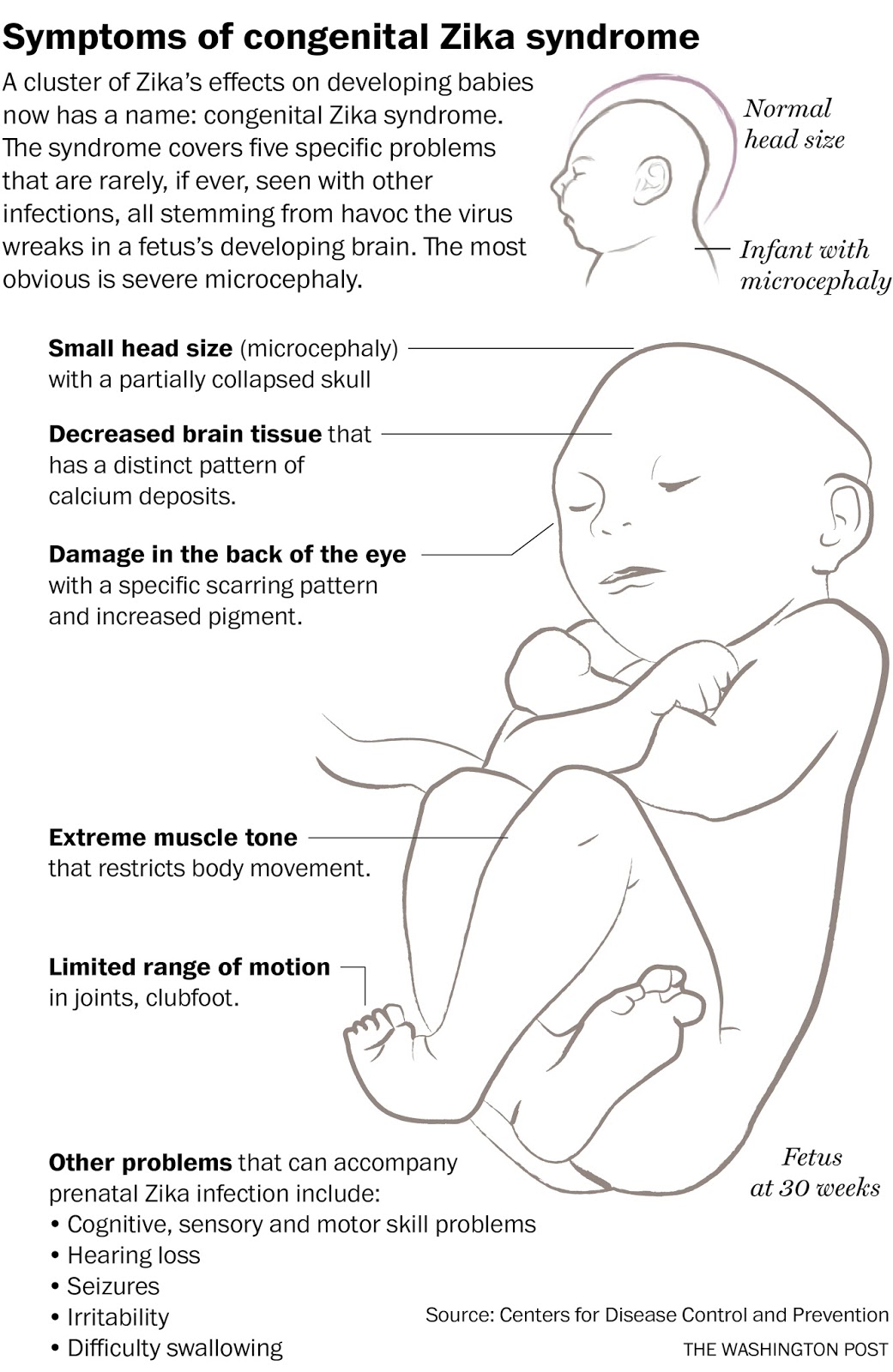 Normal head size at birth doesn’t rule out microcephaly, Zika syndrome ...