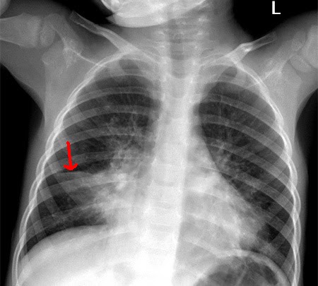 ON - RADIOLOGY: Pneumonia in the Right middle lobe
