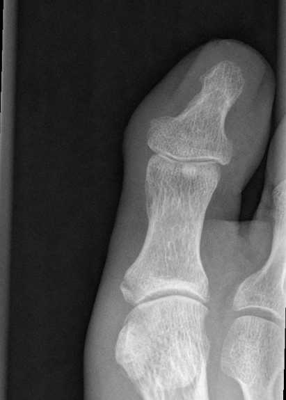 Fanáticos del pie: ATLAS DE PATOLOGIA DEL PIE: FRACTURA DE FALANGE ...