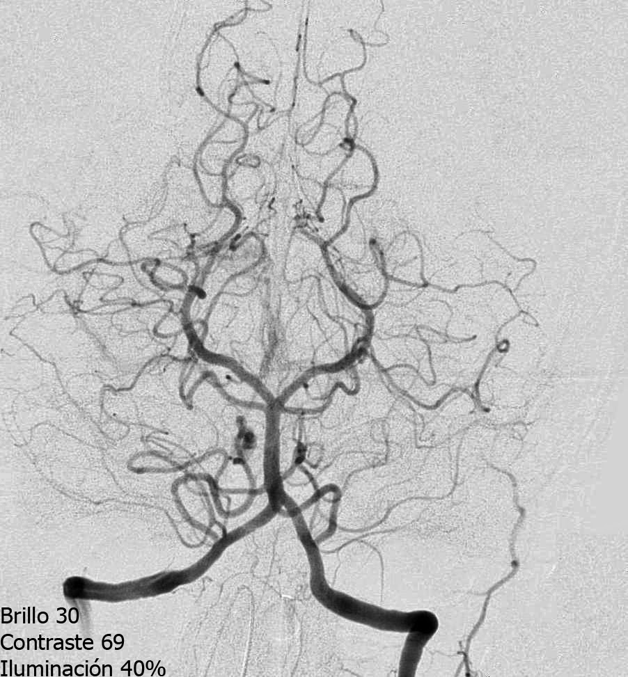 Enfermedad Cerebrovascular (ECV): Prueba de Screening y Confirmatoria ...