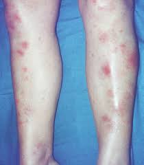 Prepare for Medical Exams : A 27 Year Old Man Presents With Several Red ...