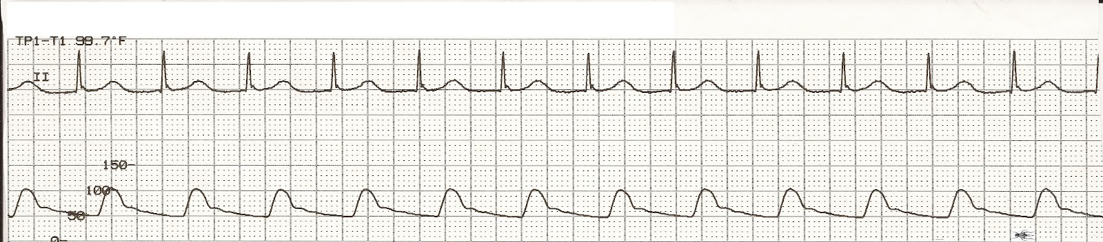 EKG Rhythm Strips 28: Junctional Rhythms