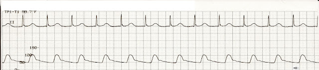 EKG Rhythm Strips 28: Junctional Rhythms