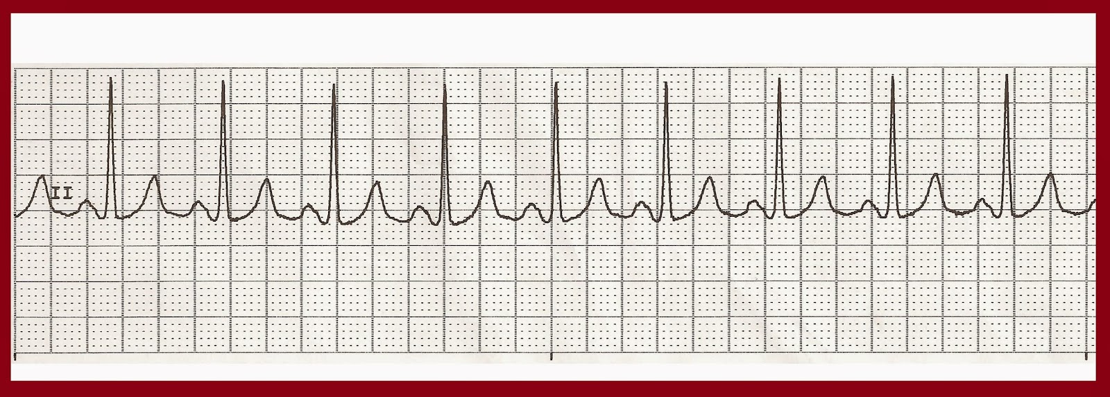 Practice EKG Strips 411