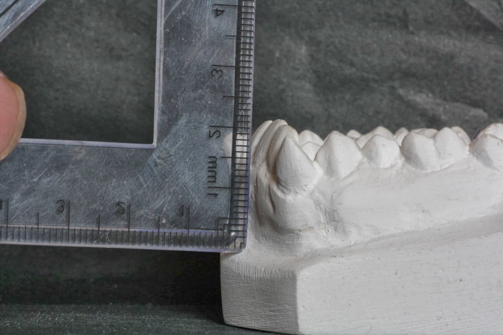 Orthodontics: UG Model Analysis Measurement of Proclination