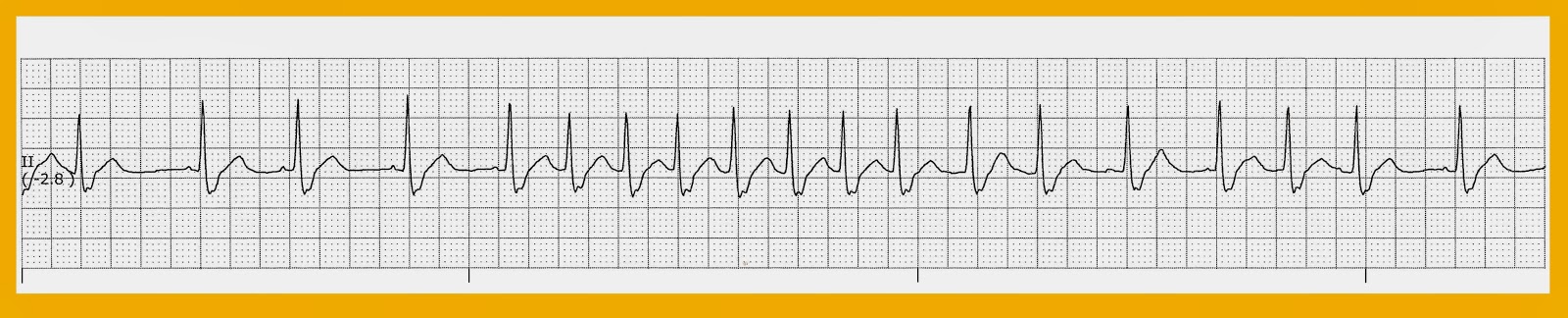 EKG Rhythm Quiz 272