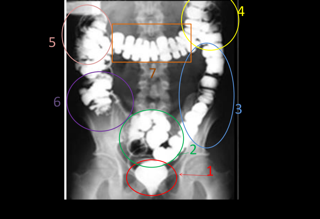 O Que é Enema Opaco - RETOEDU