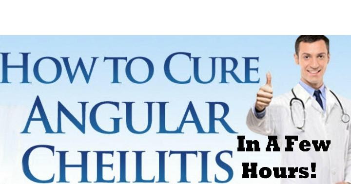 How To Have A Healthy Life Most Common Causes Of Angular Cheilitis And