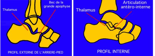 Sustentaculum Tali Fracture