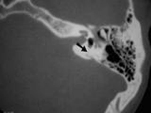 Pyothorax Without Fistula