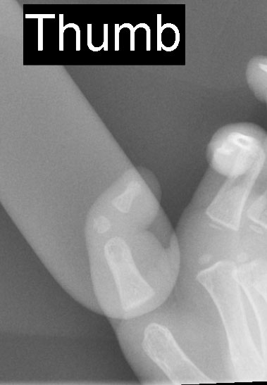 The Crooked Thumb | Congenital Hand and Arm Differences | Washington ...