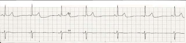 EKG Rhythm Strip Quiz 4