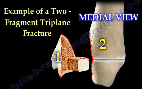 Dr. Nabil Ebraheim's Blogspot: Triplane Fracture of the Distal Tibia