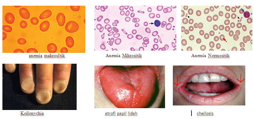 Anemia Defisiensi Besi - Fadhila Alizza