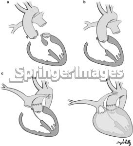 Pedi cardiology: Surgery: Transposition (d-TGA), SubPS, Nikaidoh Procedure