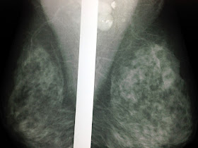 VIETNAMESE MEDIC ULTRASOUND: CASE 343: TB AXILLARY NODES, Dr PHAN THANH ...